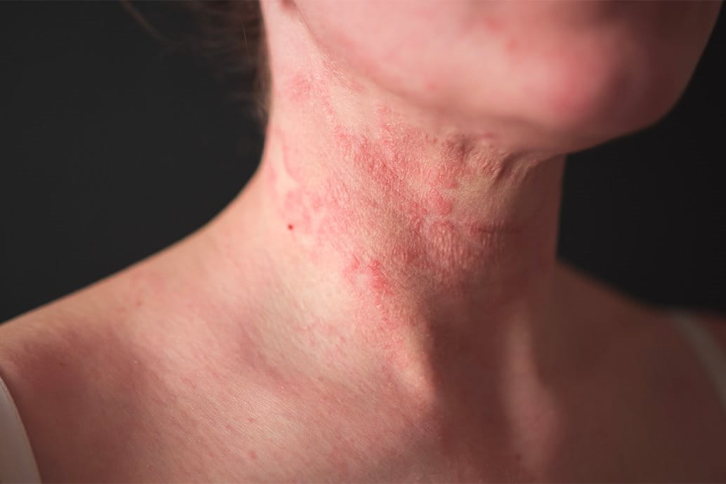 Dermatite da stress: sintomi, cause, sintomi e rimedi | Eucerin