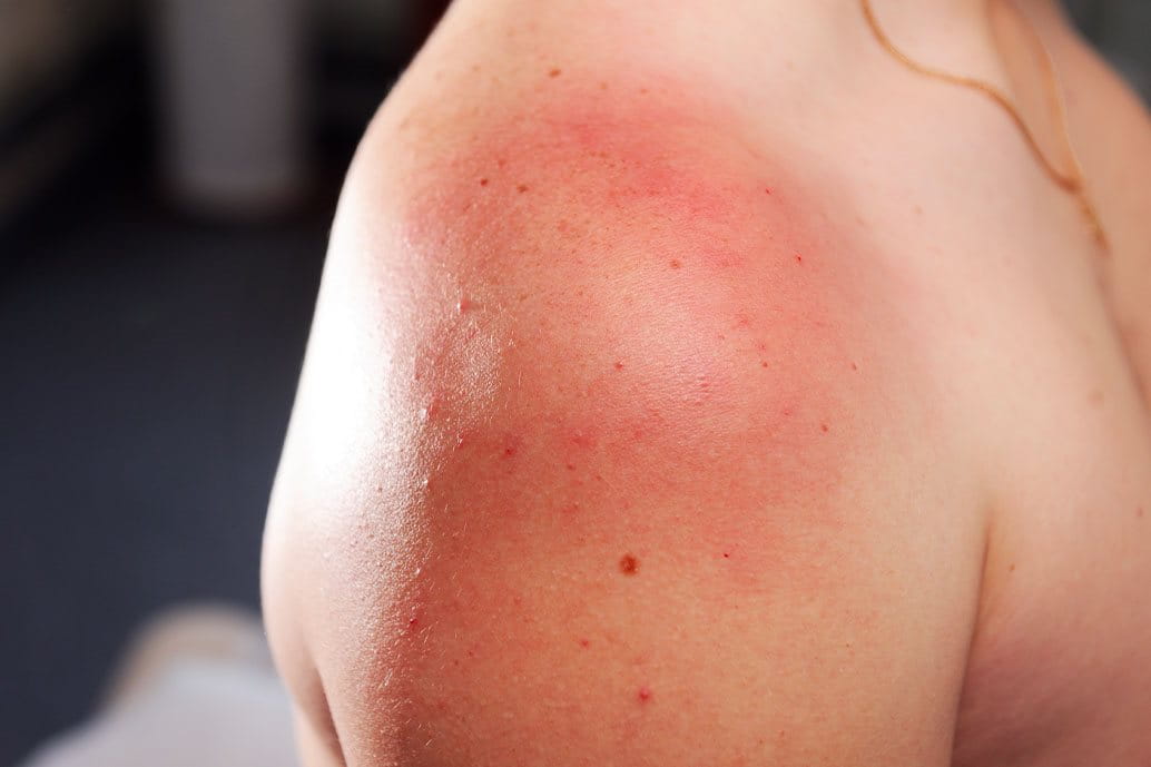 Dermatite da stress: sintomi, cause, sintomi e rimedi | Eucerin