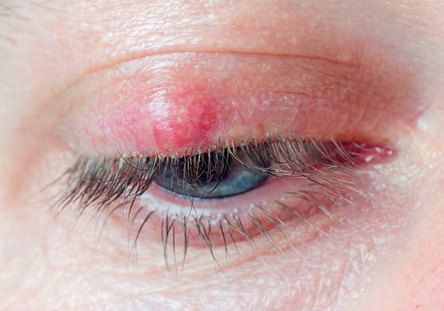 Dermatite Palpebrale: cause, sintomi, rimedi e cura | Eucerin