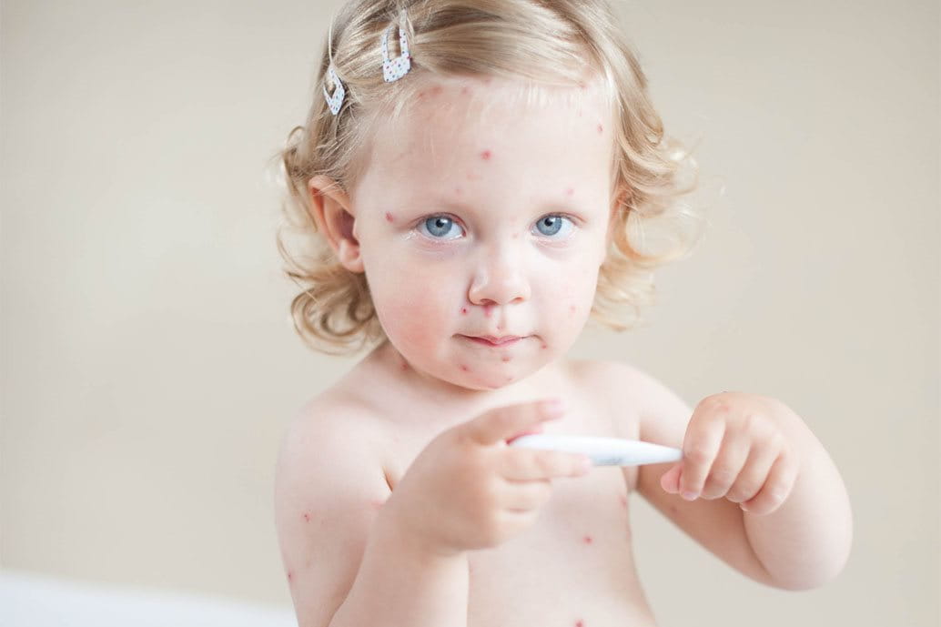 Macchie e cicatrici da varicella: prevenzione e cura | Eucerin