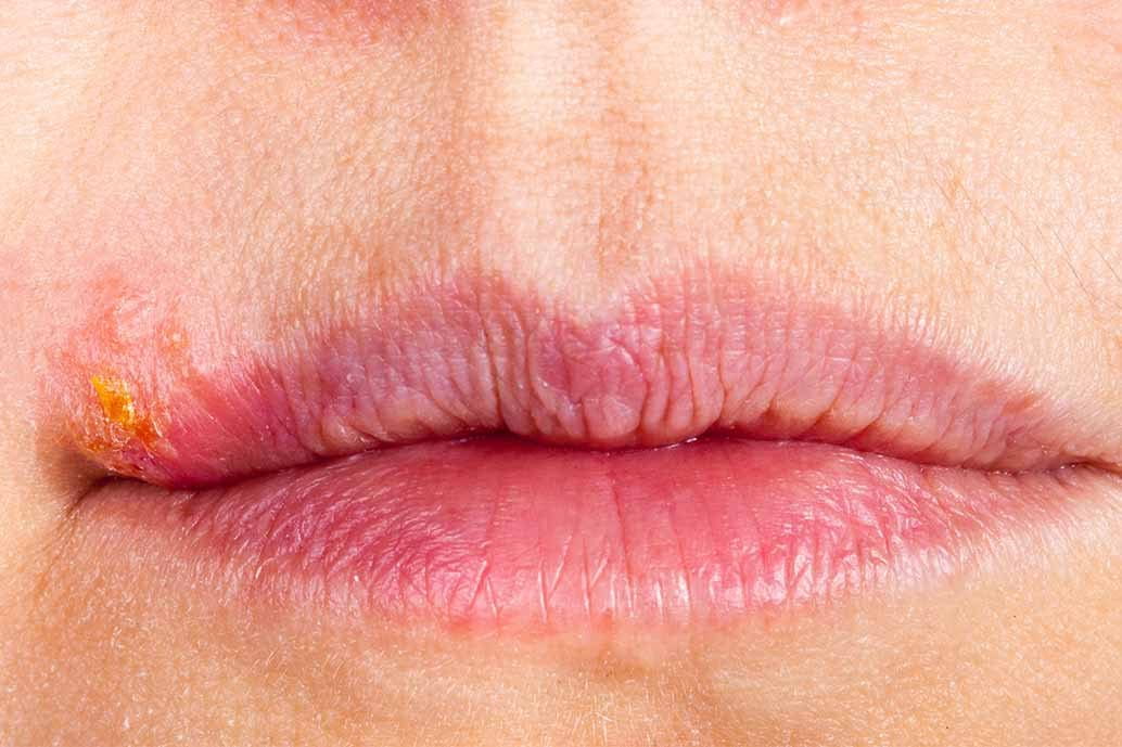 Cheilite angolare: cos'è, perché si forma e come curarla | Eucerin