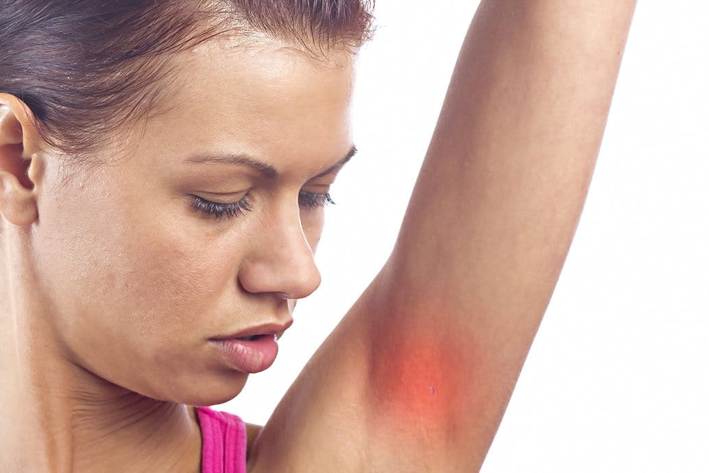 Dermatite da sudore: sintomi, cause e rimedi | Eucerin