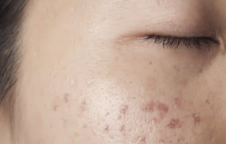 Hyperpigmentation caused by inflammation