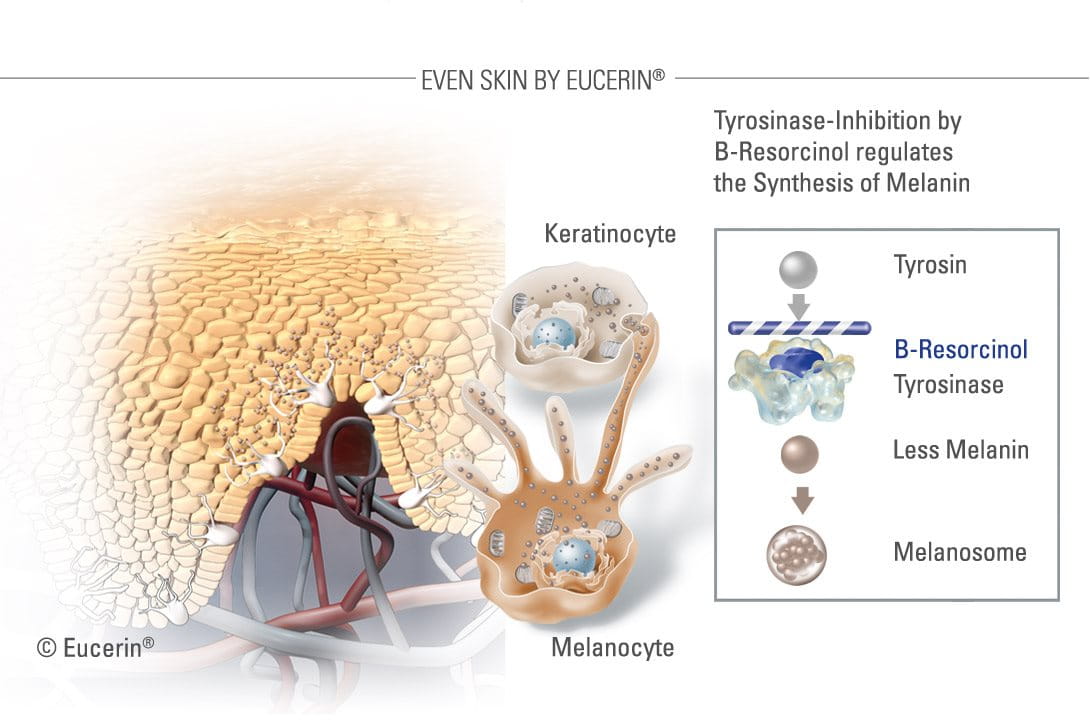 Hyperpigmentation caused by inflammation