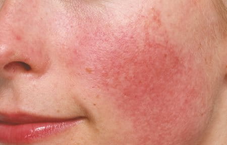 Hypersensitive skin: causes, symptoms, triggers, and solutions ...