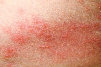 Neurodermitis erkennen und behandeln | Eucerin