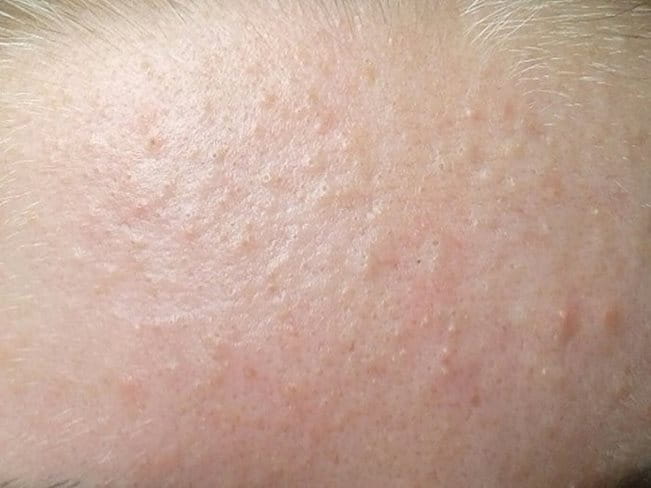 Mụn li ti: Nguyên nhân và Cách điều trị cực kỳ hiệu quả