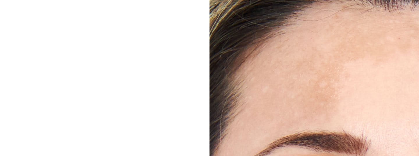 Anti-Pigment | Hyperpigmentering| Eucerin